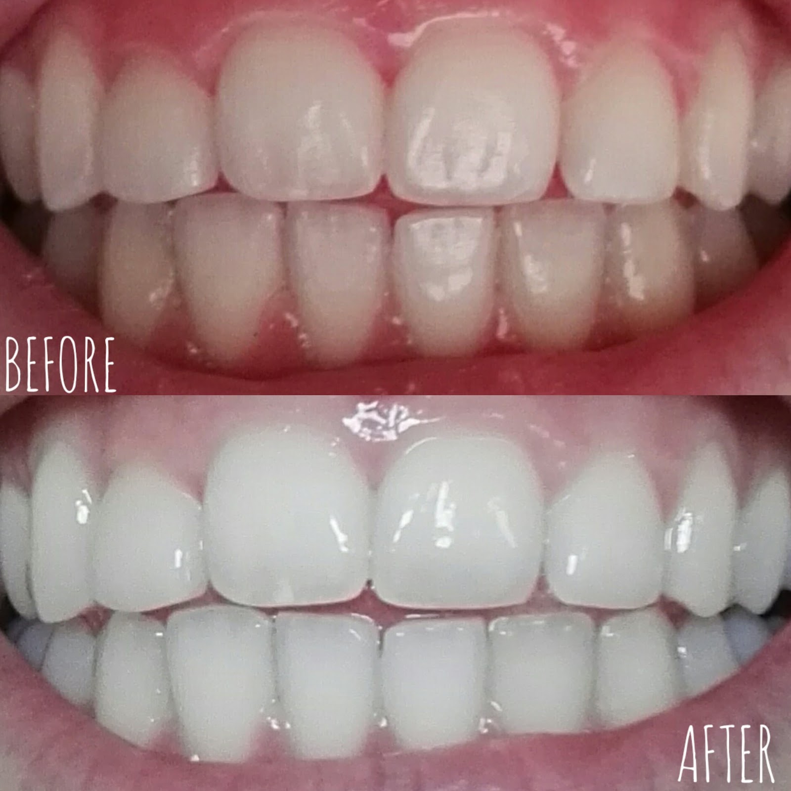 White Glo Teeth Whitening Reviewed | The Daily Catchup
