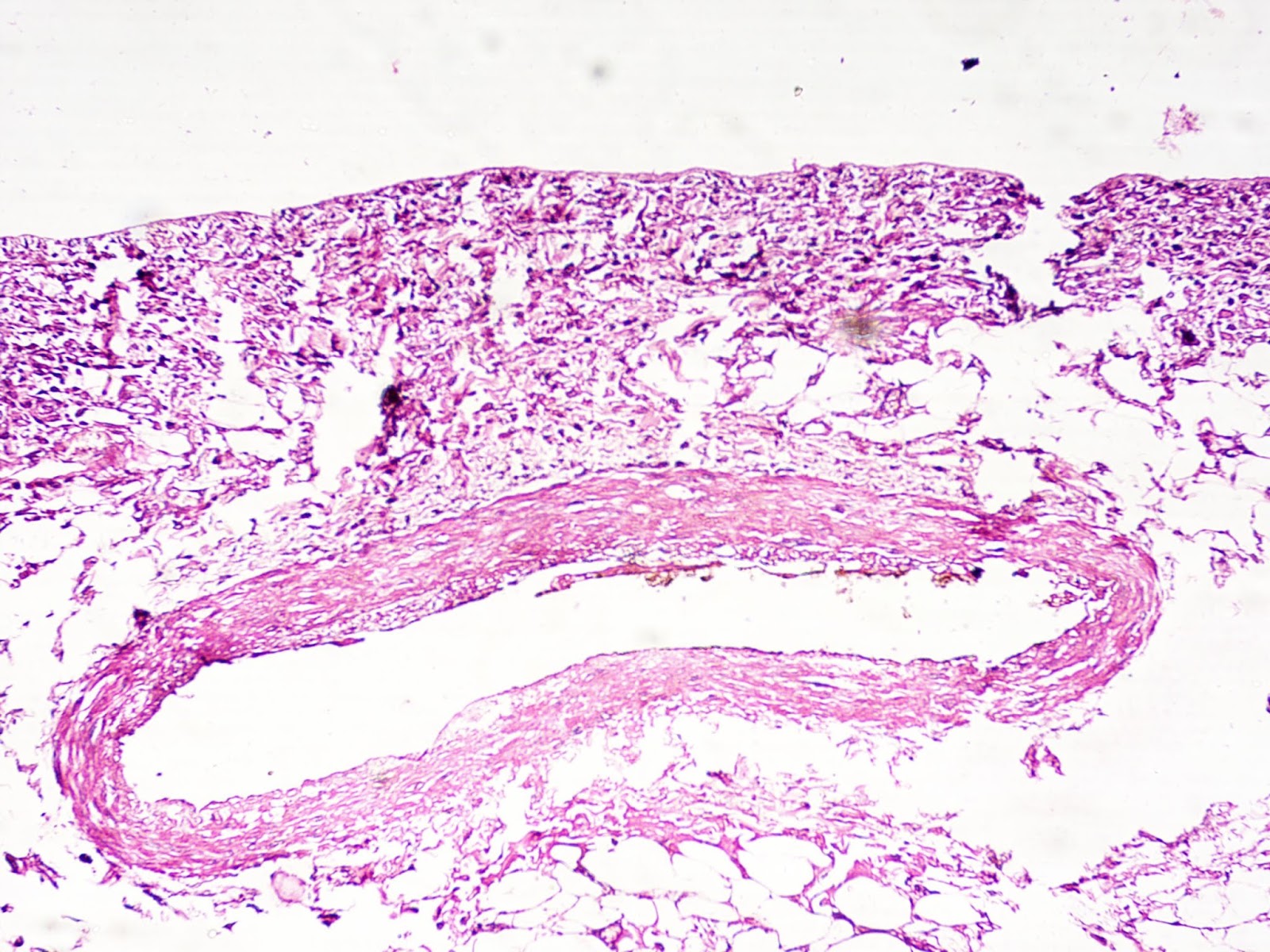 into the roots: Pericarditis