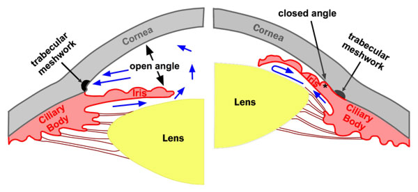 Glaucoma secundario de ángulo abierto Pretrabecular