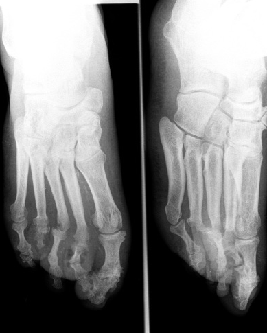 Tecnicos Radiologos: Pie diabético: hallazgos en Diagnóstico por Imagen ...