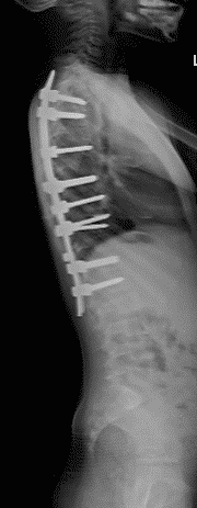 Shilla Growth Guidance Procedure | Growing Spine Blog | Washington ...