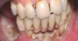 What is Phossy Jaw - Definition, Symptoms, Causes, Treatment - Health ...