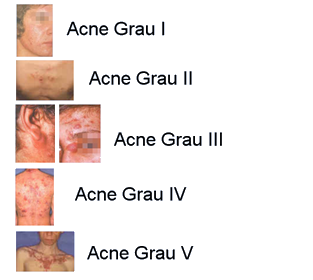 Perfil Fotodepilação: Acne