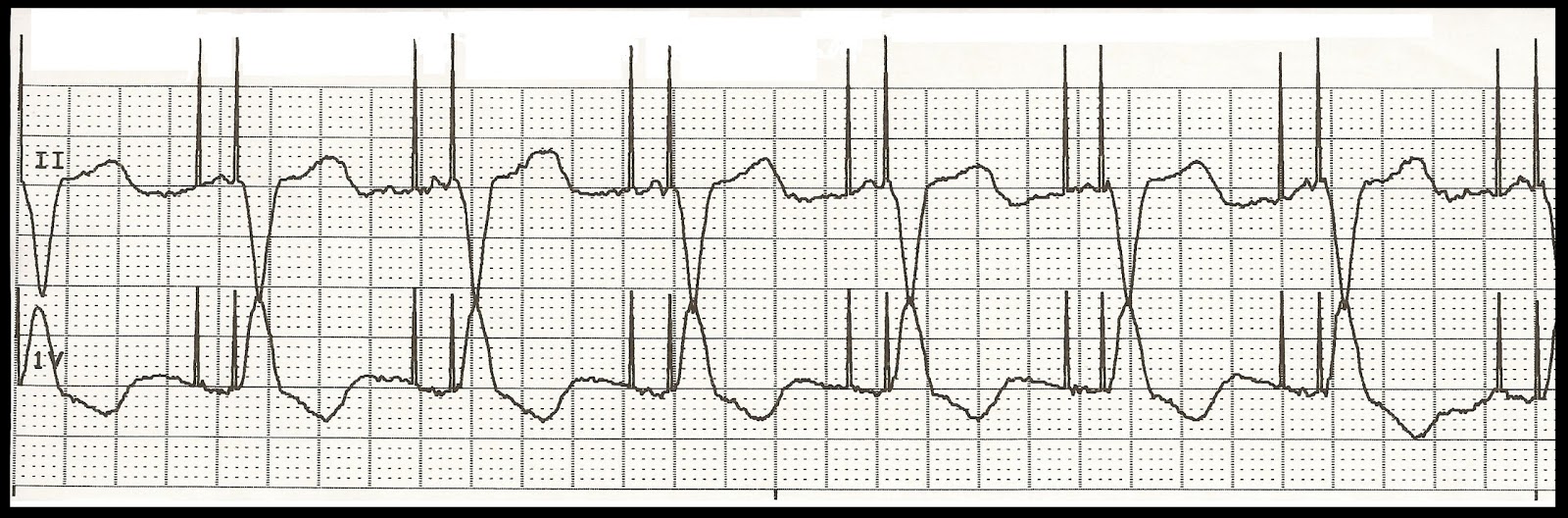 ECG Rhythm Strip Quiz 118