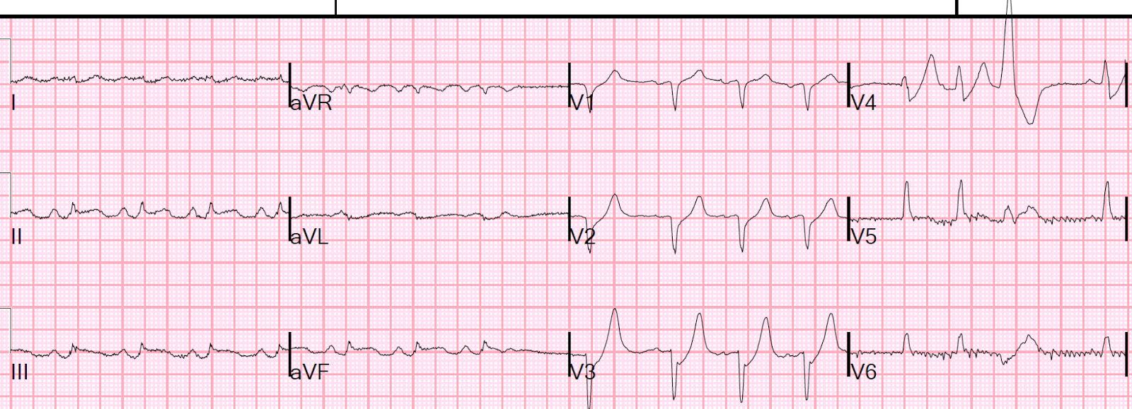 ACLS REVISION: De Winter's T-waves in precordial leads and ST elevation ...