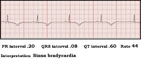 ECG Rhythm Strip Quiz 81: Interval measurements