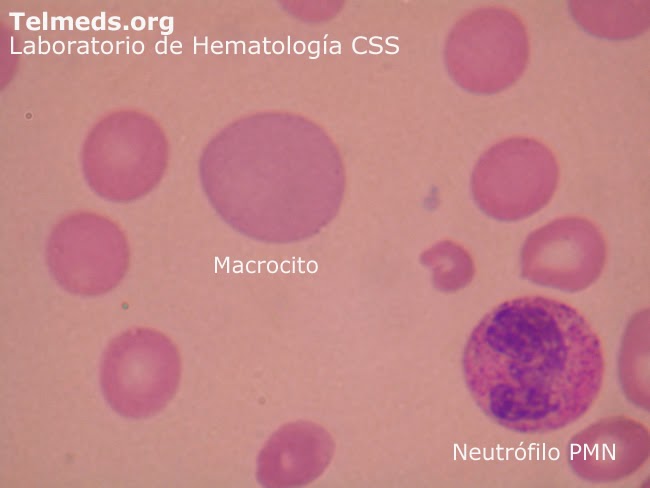 HEMATOLOGIA: MACROCITOSIS