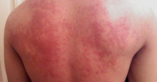 Daily health information - Peanut allergy in children | Health ...