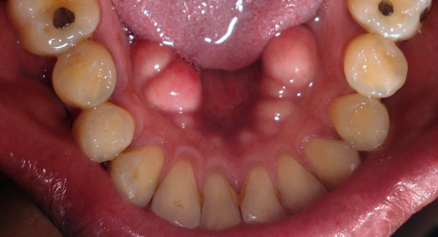 Exostosis Dental Exostosis Dental