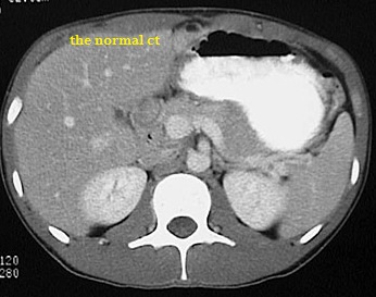 CT abdomen with contrast the suspect multiple hepatic nodules ...