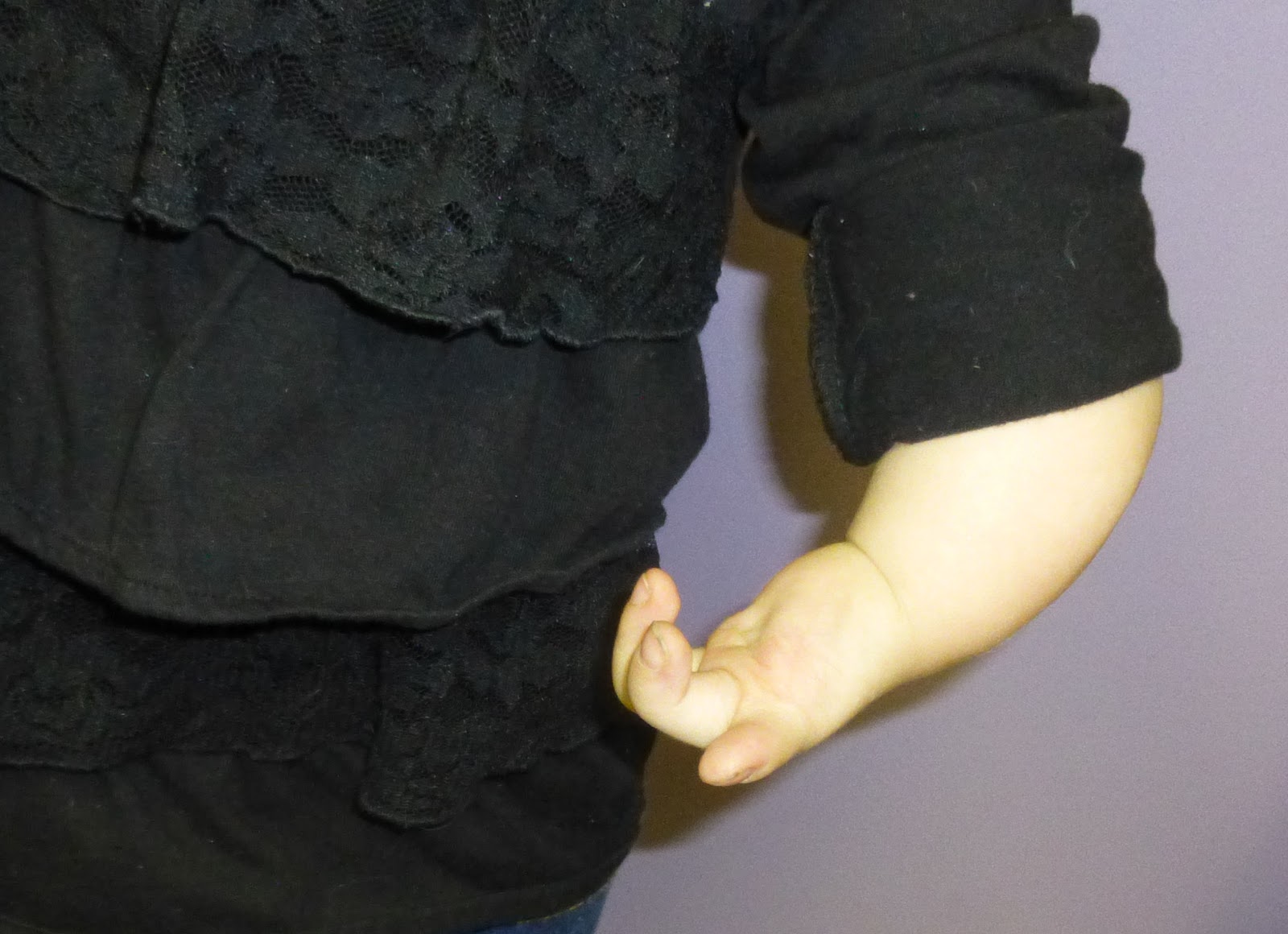 Ulnar deficiency, considerations for surgery | Congenital Hand and Arm ...