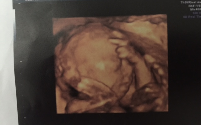 Independent Me !!!: Pregnancy Diary : 22 Weeks Check up and Anomaly Scan