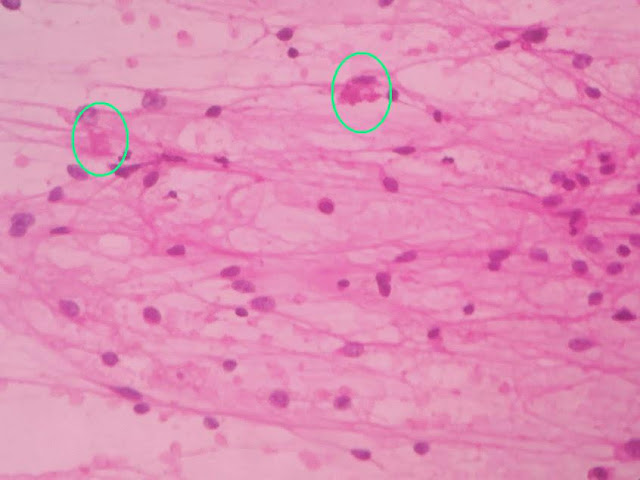 KIMAN - Making pathology simple!!: Pilocytic astrocytoma - Squash ...
