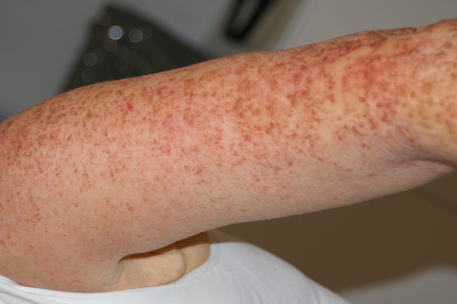 comment éliminer les cicatrices d'acné internet