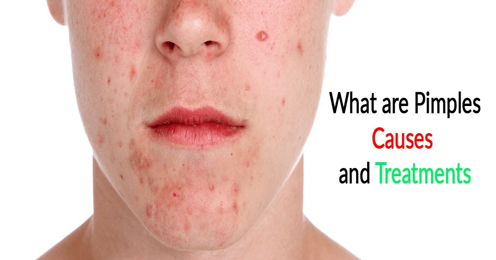 What are Pimples,Causes and Treatments - Care Online
