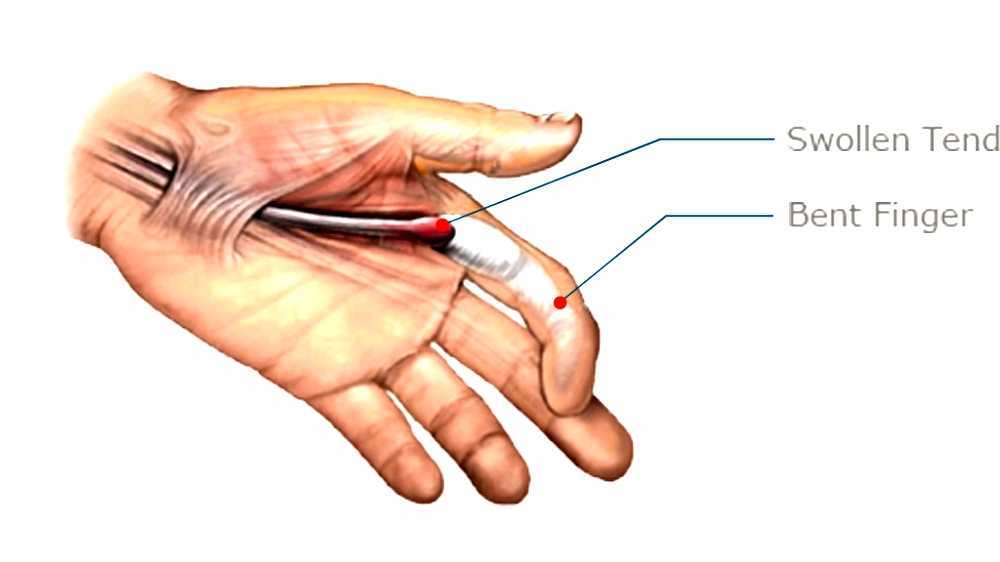 Stenosing tenosynovitis