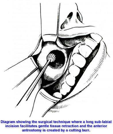 WizDent: Caldwell-Luc operation