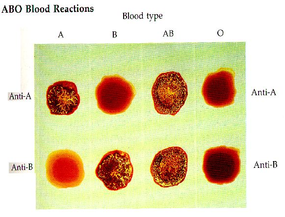 Aroldo Filho ... Biomedicina: AGLUTINAÇÃO SANGUINEA