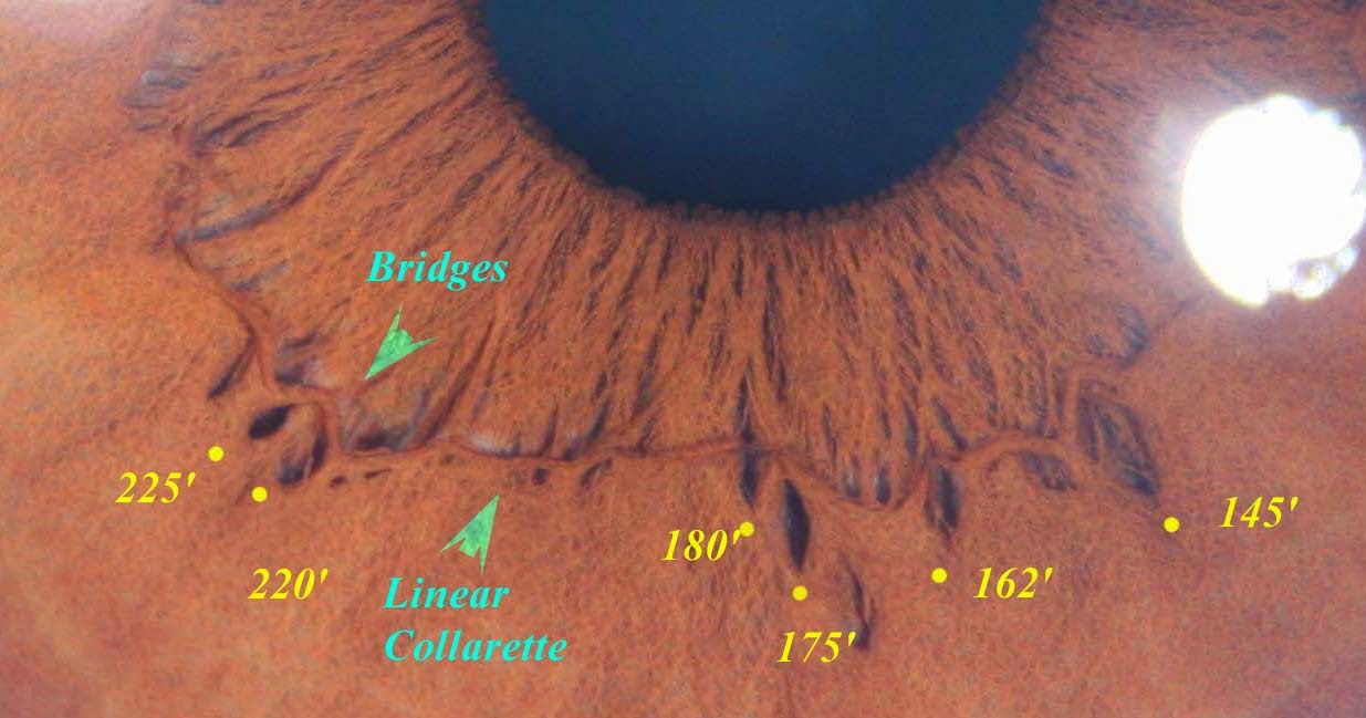 Modern & Multidimensional Iridology: Pupil Flatness, Collarette ...
