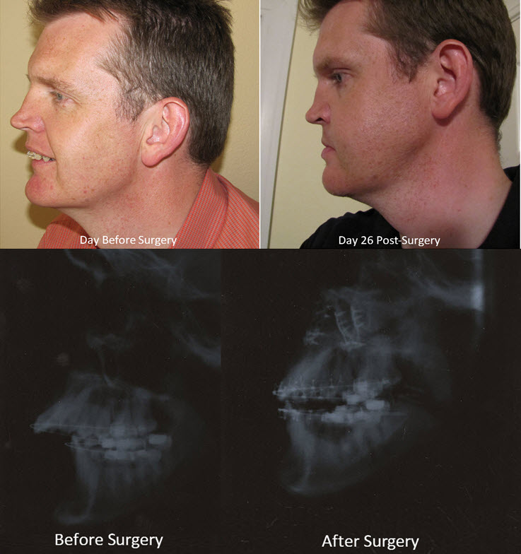 Double Jaw Operation - The Road to Recovery