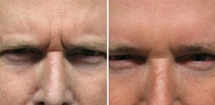 Facial Yoga Workouts To Tone And Tighten Face Tissue And Muscle ...