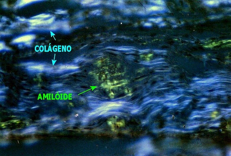 Estomatologia Online: Amiloidose
