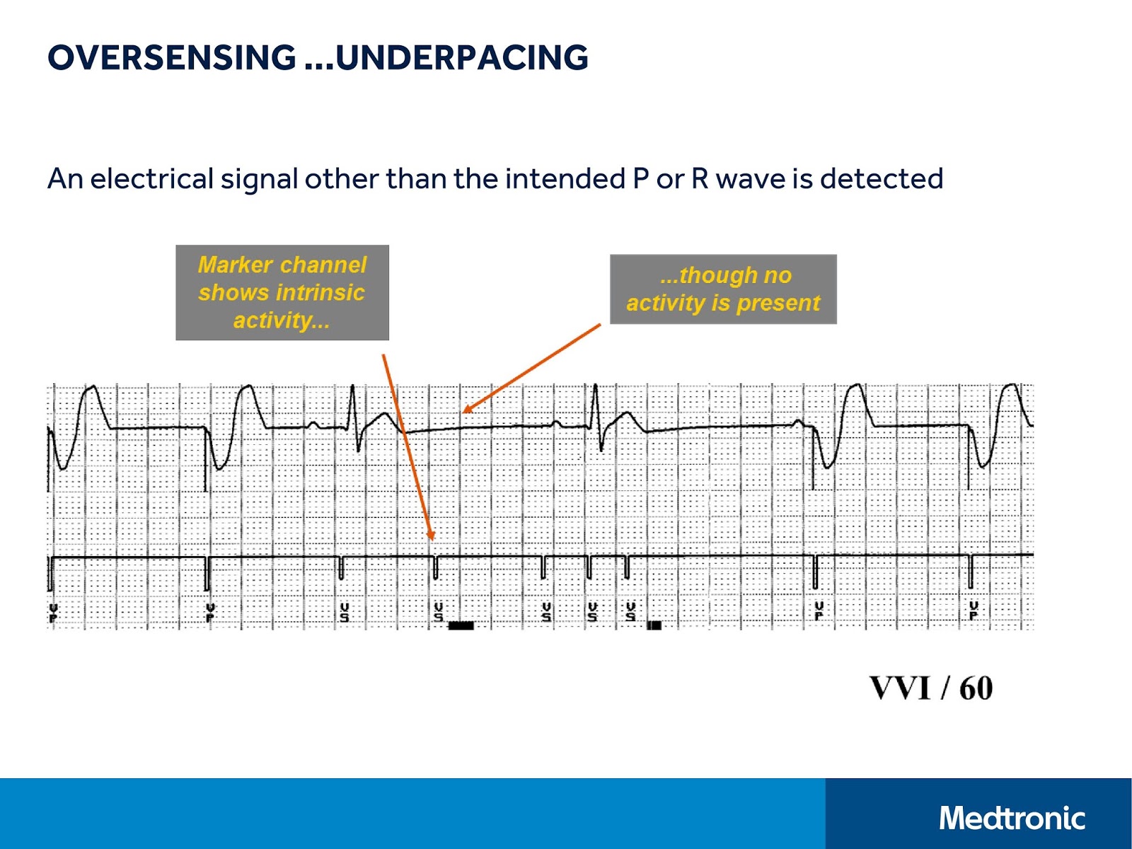 CVT Mohd Farid: Basic Pacing Concepts Part II-Medtronic Academy