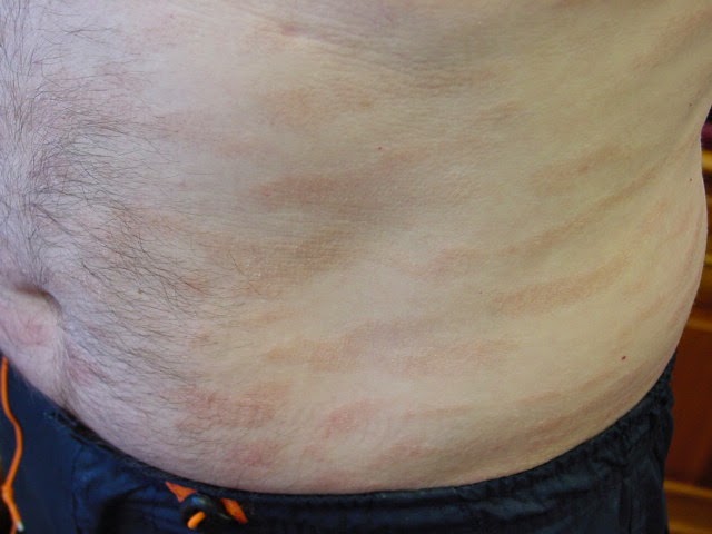 Dermatopathology Made Simple - Inflammatory: Psoriasiform Reaction Pattern