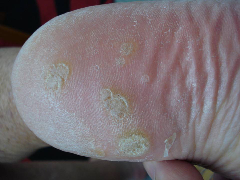 Consultations in Dermatology: The Persistent Invaders- Warts