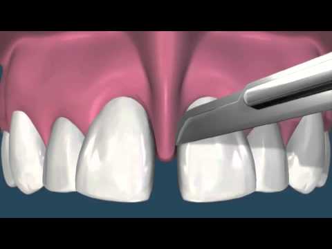 ¿Que es? y como se hace una frenectomía labial | Odontología al Dia