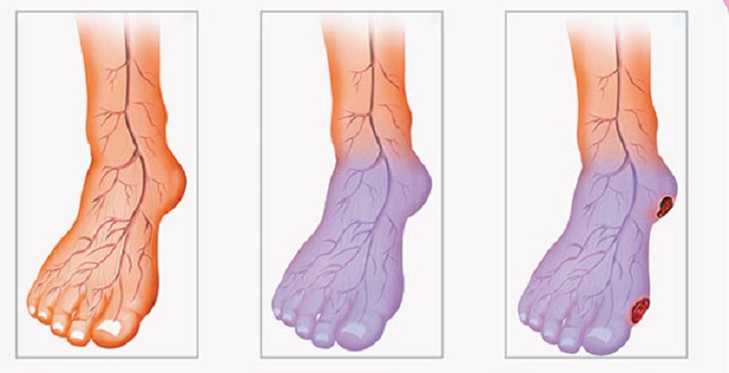 Poor Blood Circulation, Cold Legs and Hands? Here is What You Can do to ...