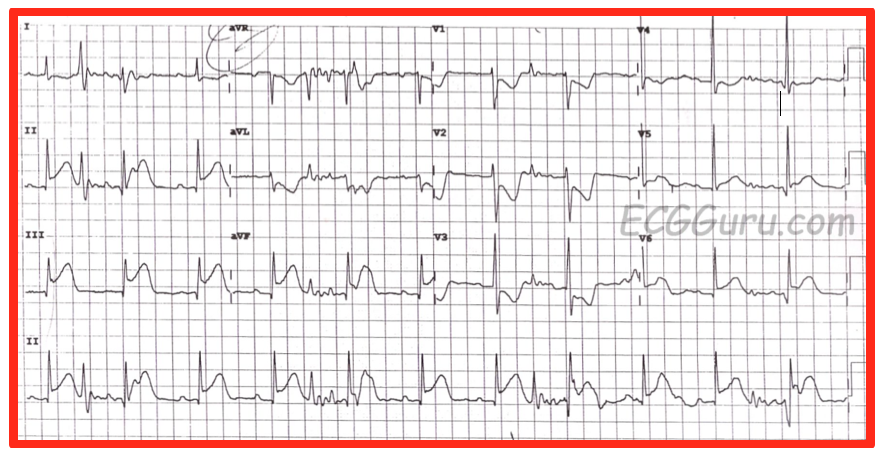 ECG Interpretation: ECG Blog #103 (My ECG Guru Comments-1) - Acute MI ...