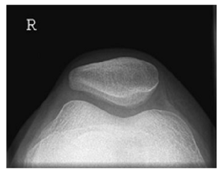 Teknik Pemeriksaan Radiologi pada kasus patela - Seputar Kesehatan