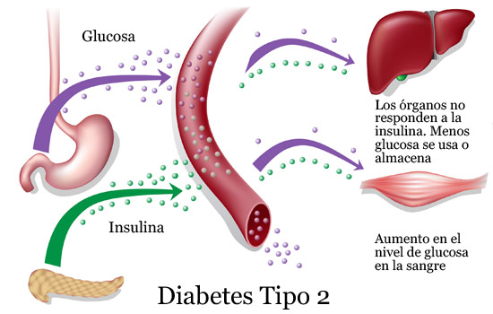 ¿Qué es la Diabetes Mellitus Tipo 2? ~ Diabetes Mellitus Tipo 2
