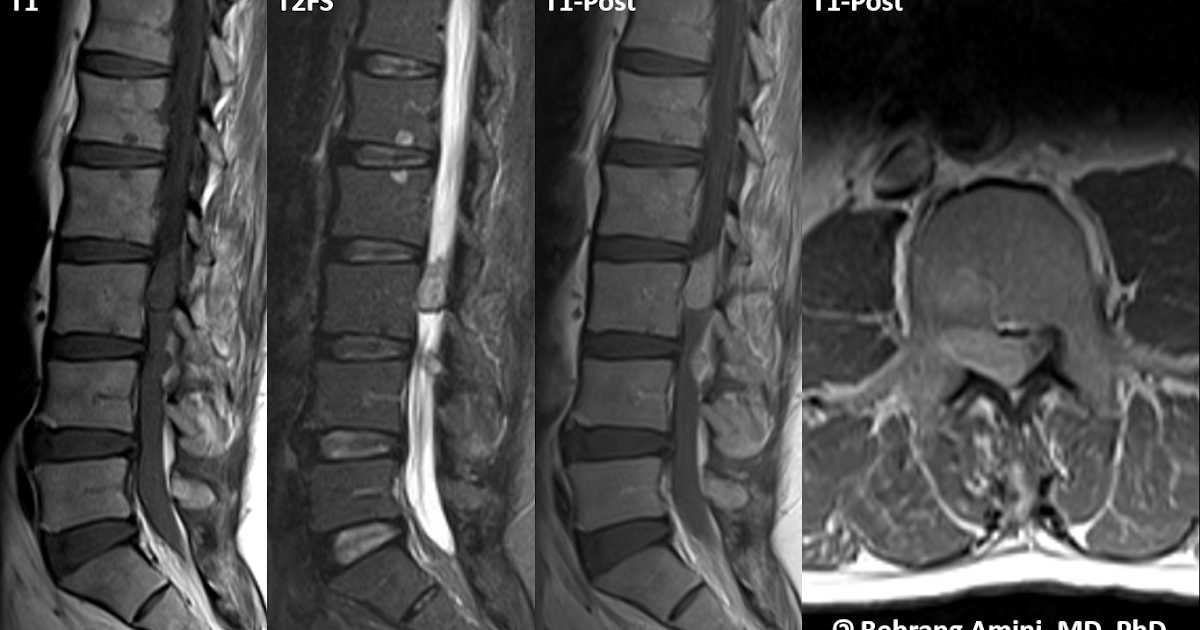 Roentgen Ray Reader: Chordoma Drop Metastases