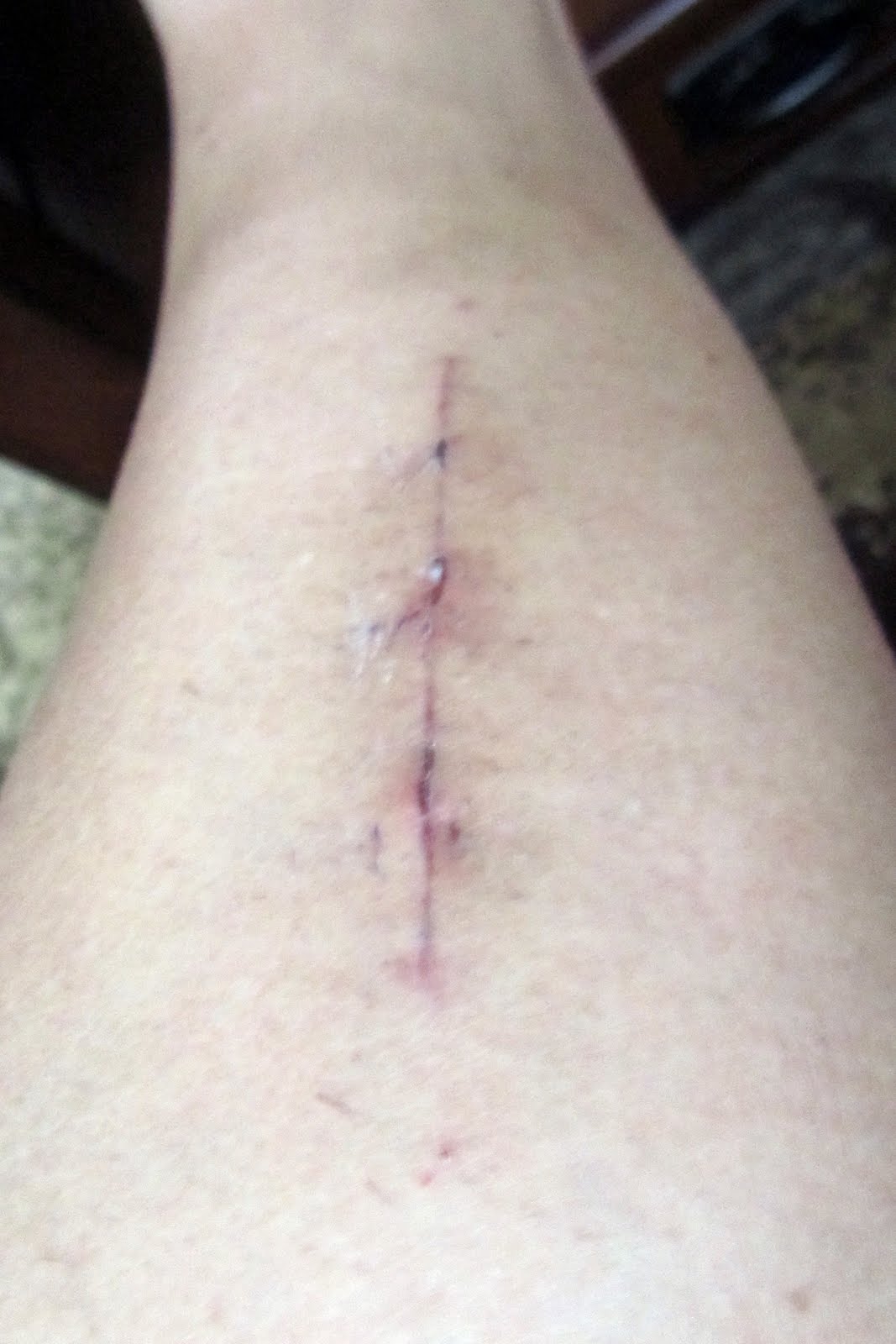 My Experience with Chronic Exertional Compartment Syndrome: My Progress