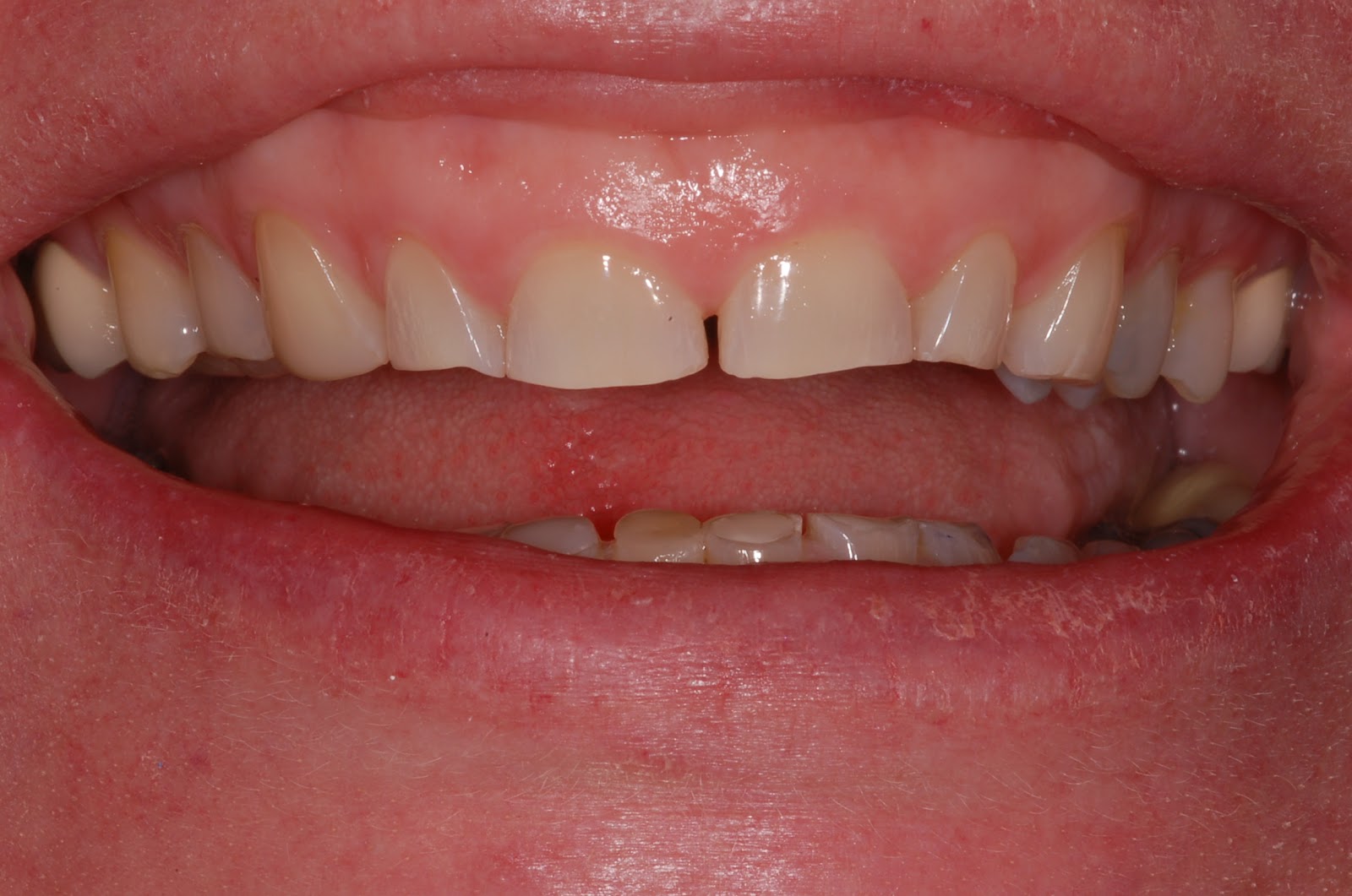 Ground down teeth? - Bauer Smiles