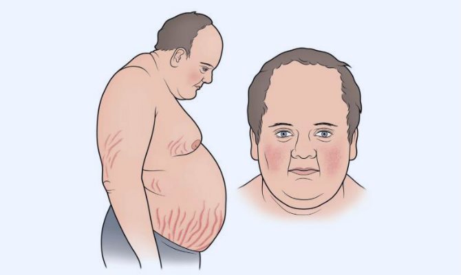 Hypercortisolism Definition, Symptoms, Causes, Treatment - Health Care ...