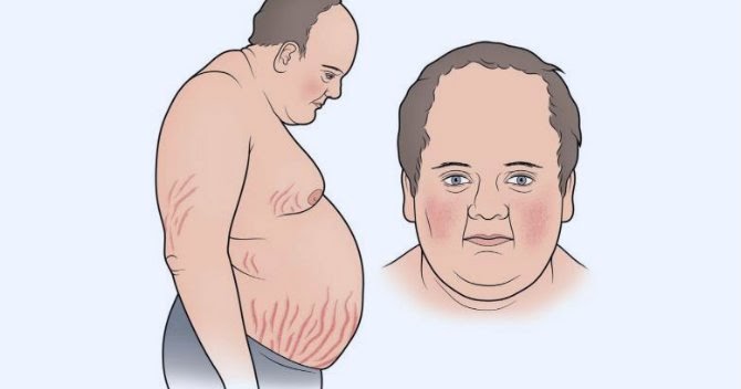 Hypercortisolism Definition, Symptoms, Causes, Treatment - Health Care ...