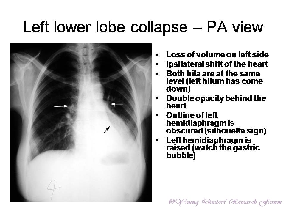 Identification of Chest X-rays of Common Lung Diseases ~ YOUNG DOCTORS ...