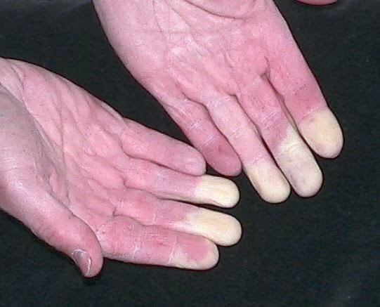Help with your feet: Raynaud's Phenomenon