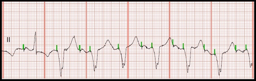 EKG Rhythm Strip Quiz 169