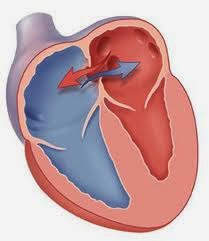 Medical Treatment Pictures-for Better Understanding: Ventricular Septal ...