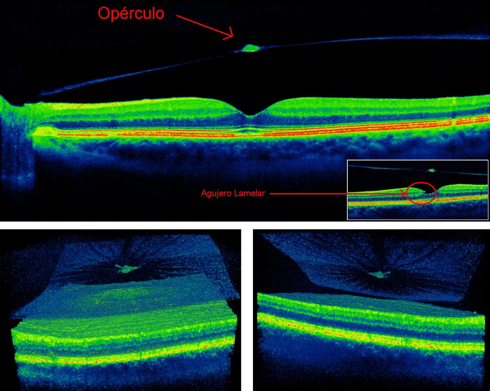 Tomografía de Coherencia Óptica