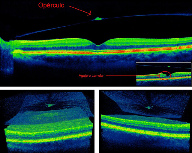 Tomografía de Coherencia Óptica