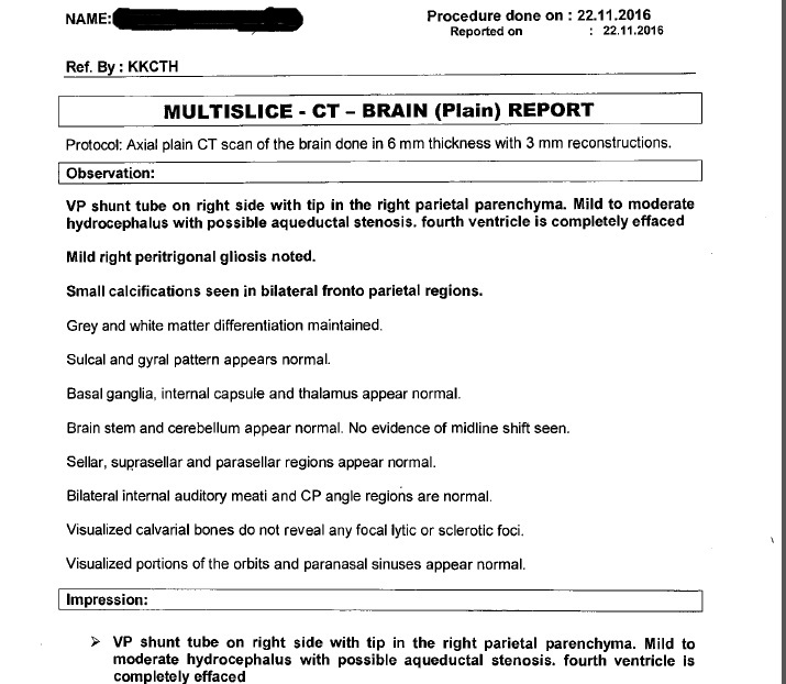 J Suresh Kumar: Vision Loss due to Hydrocephallus - VP Shunt Revision