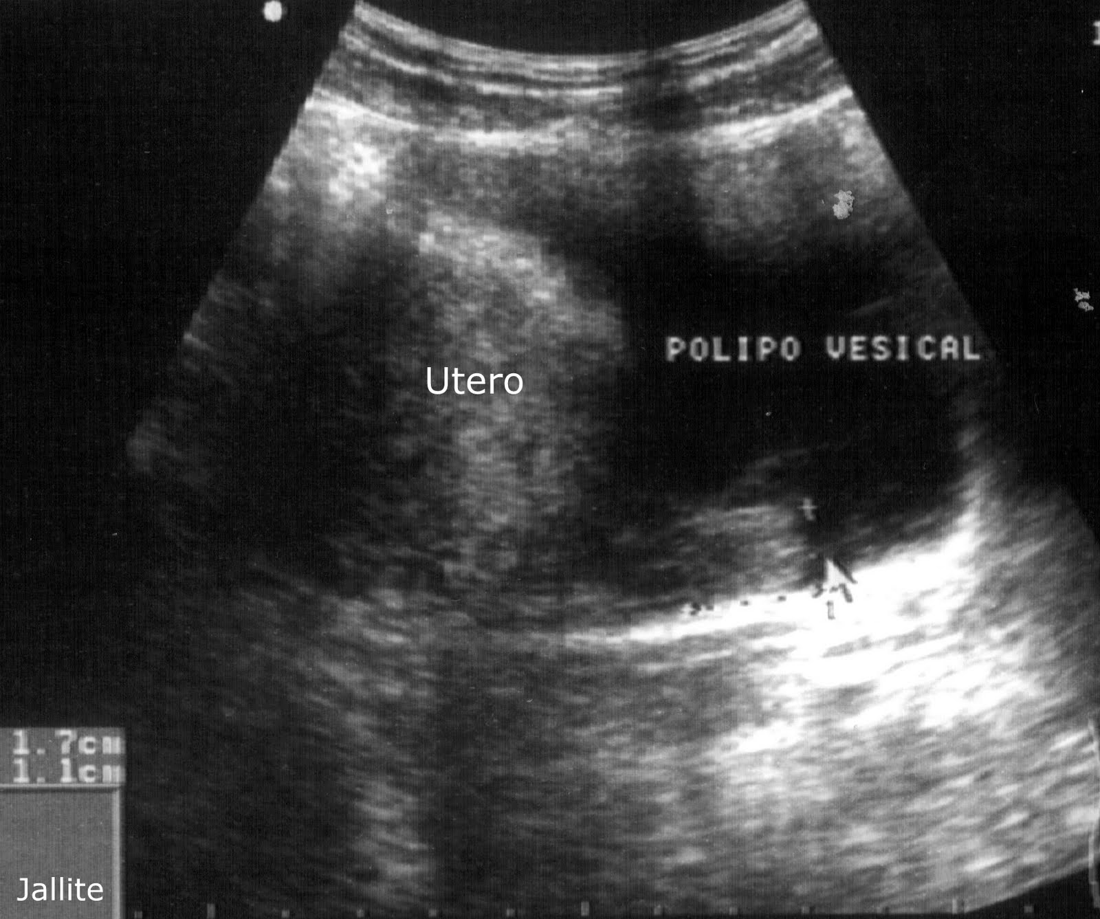 Polipo Vesical en 3D