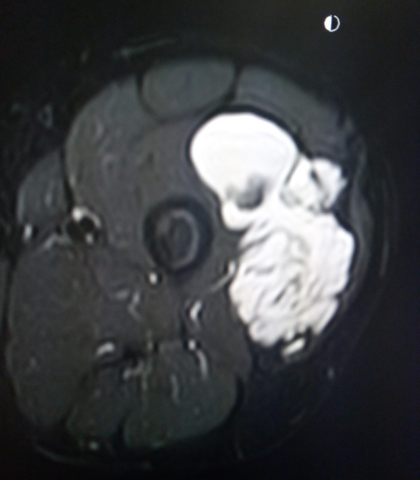 Case Report Soft Tissue Cavernous Hemangioma Sumers Radiology Blog