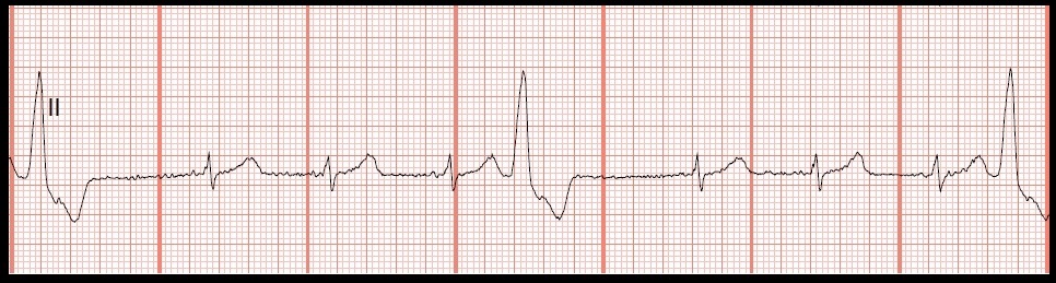 EKG Rhythm Strip Quiz 166