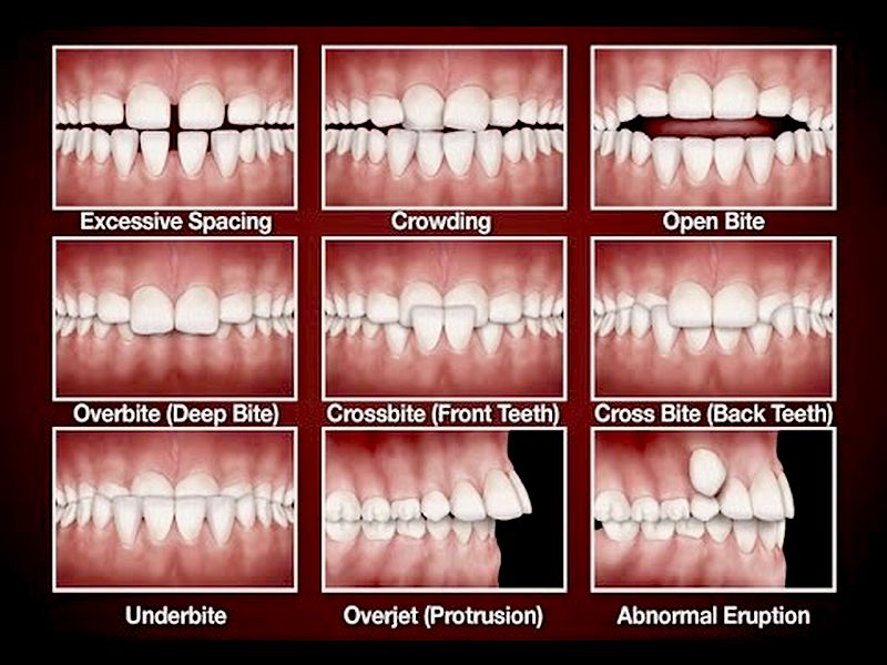 INTERVIEW: Early symptoms of Orthodontic problems by Prof John Mew